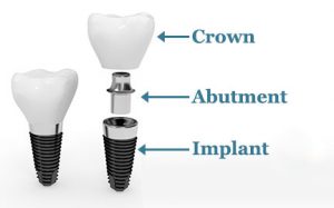 Implant Crowns - dentoamerica