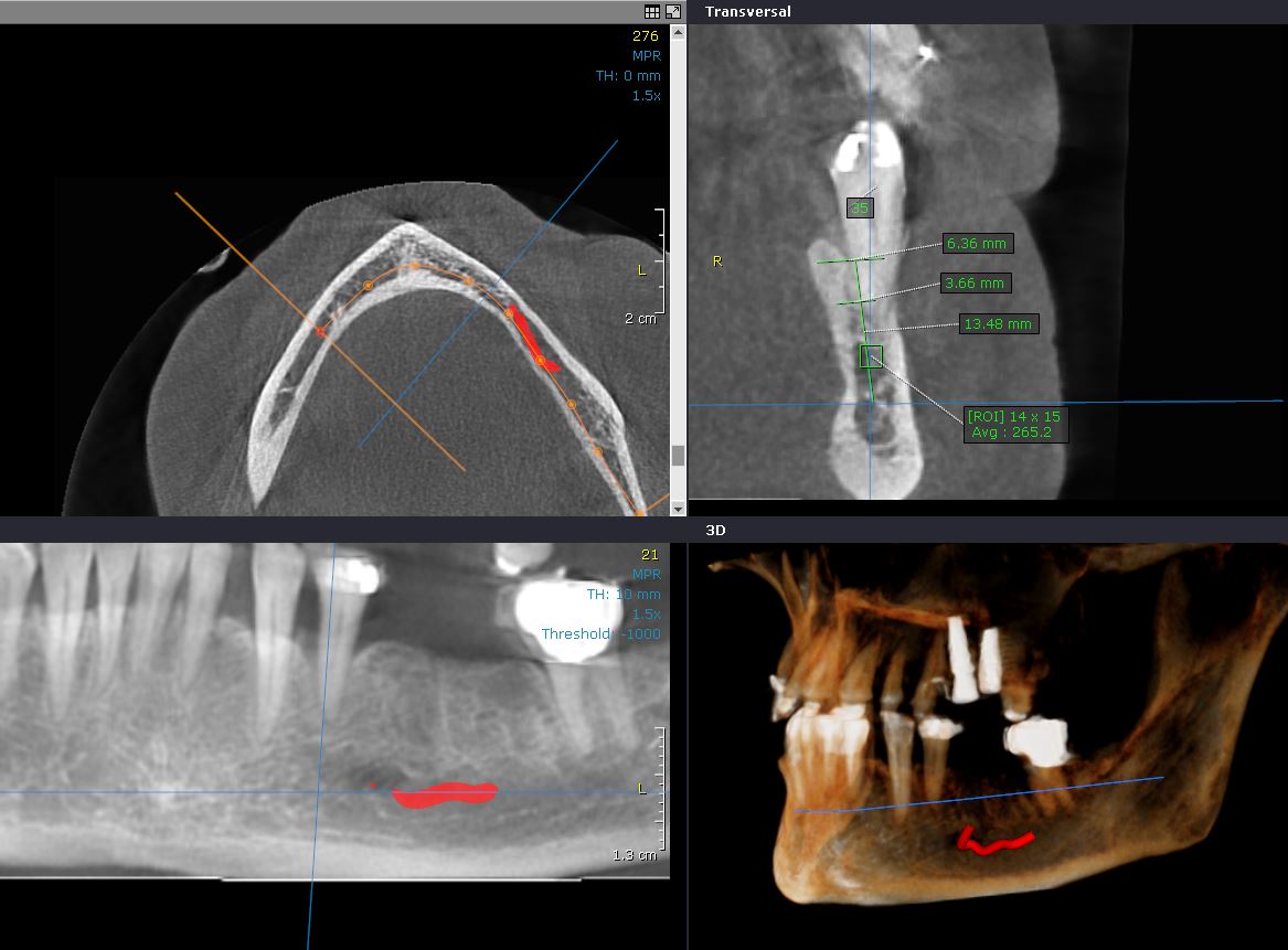 Extraction & Implant Timeline - dentoamerica